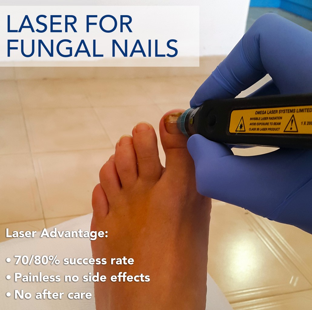 Laser for Fungal Nails – Foot Podiatrist